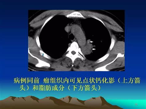 肺错构瘤影像表现没有必要影像学第8页大山谷图库