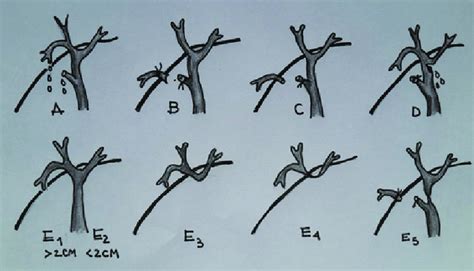 2 Clasificación De Strasberg De Lqvb Download Scientific Diagram