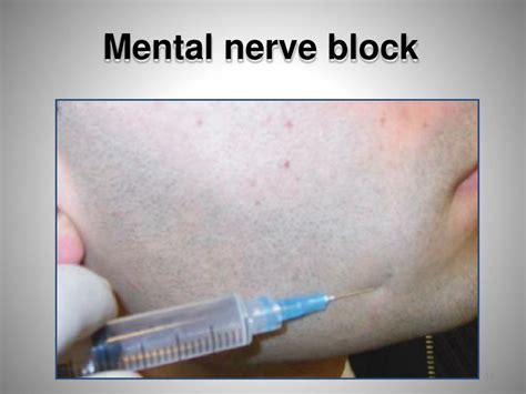 Ppt Local And Regional Anesthesia Powerpoint Presentation Free