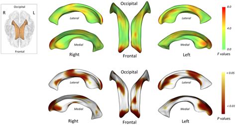 Locations Of Shape Differences In The Lateral Ventricles Uncorrected Download Scientific