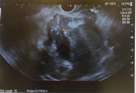 An Unusual Eus Application 83 Yo With Incidental Finding At Ct Scan Of