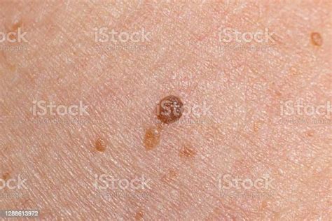 인간의 피부에 유두종 두더지의 형태로 양성 종양 모두 유두종 증의학 사마귀 피부 상태에 대한 스톡 사진 및 기타 이미지