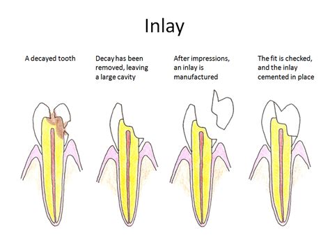 What Is The Difference Between Inlay Onlay Overlay And Pinlay News