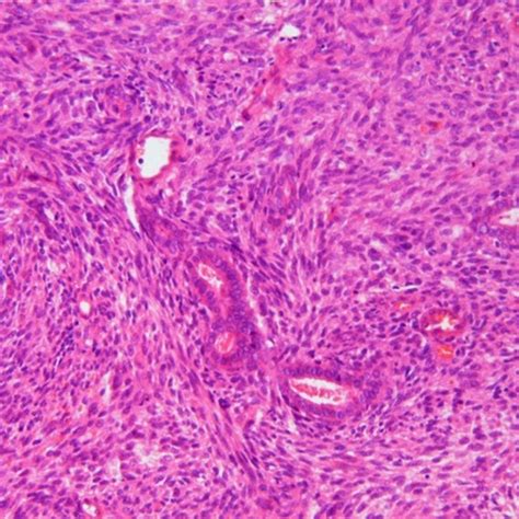 Synovial Sarcoma Biphasic Glandular Structures Are Formed Amid A Download Scientific Diagram