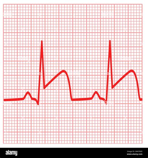 Représente Les Ecg Pour Linfarctus Du Myocarde Signe Dattaque
