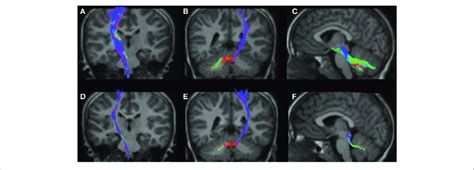 Csd Pt Upper Row And Dti Lower Row Reconstructions Of The Cst