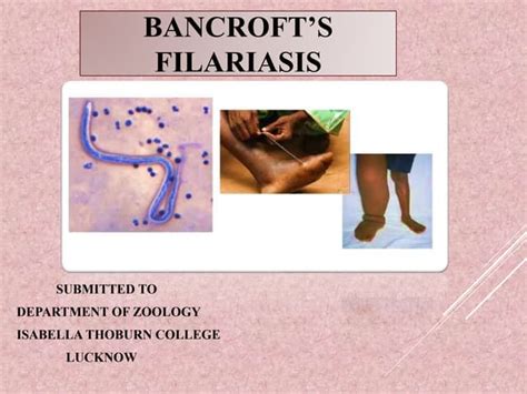 Filariasis Wuchereria Bancrofti Ppt