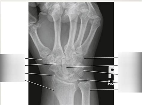 Pa Oblique Wrist Diagram Quizlet