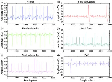 The Lead Ii Ecg Signals Of Different Arrhythmias Mv Represents Download Scientific Diagram