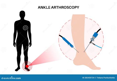 Ankle Arthroscopy Poster Stock Vector Illustration Of Arthroscope