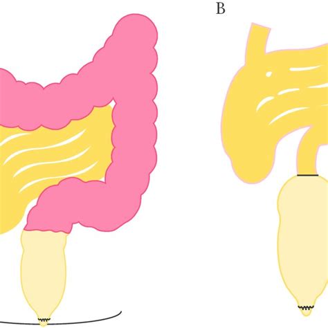 Montreal Classification Of Extent And Severity Of Ulcerative Colitis