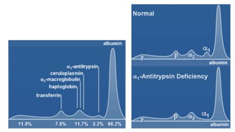 Pulmonology 26 Alpha 1 Antitrypsin Deficiency Aatd Flashcards Quizlet