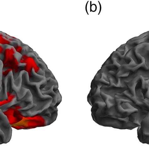 Gray Matter Volume Differences Between Spanishenglish Early Bilingual