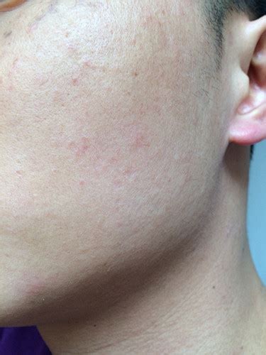 脸 肌肤干燥的搜索结果360图片