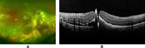 Macular Hole Formation In Eye After Cryotherapy And Intravitreal Bevac