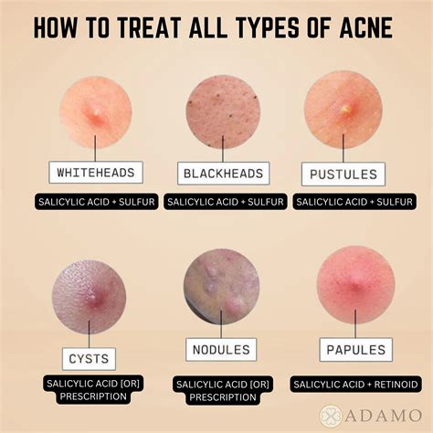 Best R Skincare Addiction Images On Pholder I Think I Damaged My Skin Barrier With