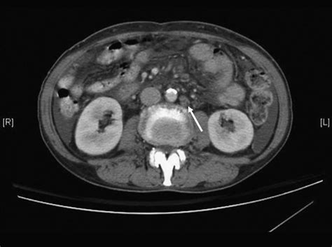 Computed Tomography Image Of A Patient With Peritoneal Tuberculosis Download Scientific Diagram
