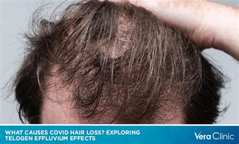 What Causes Covid Hair Loss Exploring Telogen Effluvium Effects