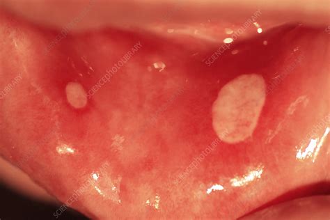 Canker Sores Stock Image C022 1884 Science Photo Library