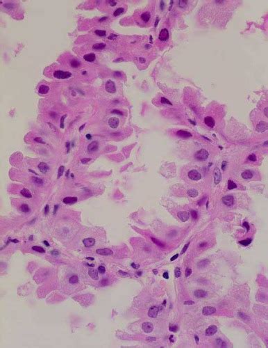 Lung Cancer Flashcards Quizlet