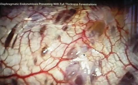 Thoracic Endometriosis — The Center For Endometriosis Care