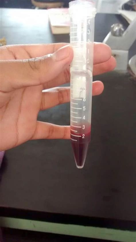 RetracciÓn Del Coagulo