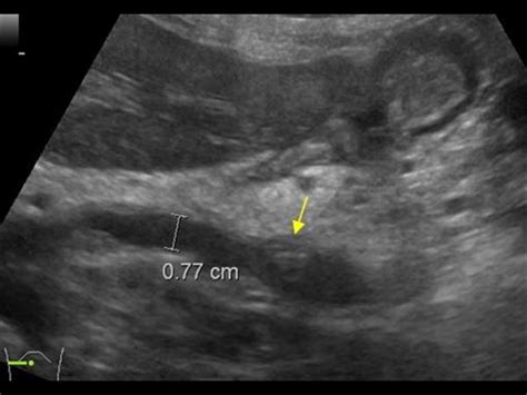 Abdomen And Retroperitoneum 12 Gallbladder And Bile Ducts Case 12