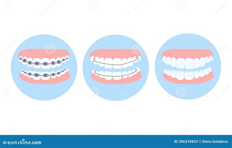 Dental Metal Braces Essix Aligner And Hawley Retainer On Human Teeth