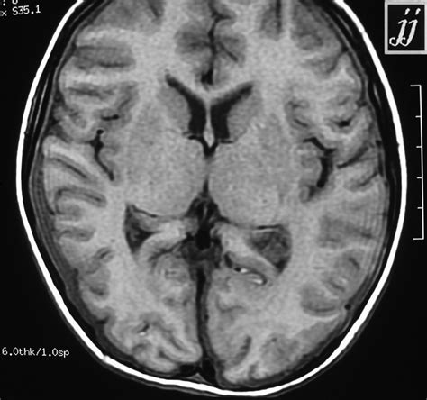 Bilateral Subdural Hygroma Radiopaedia