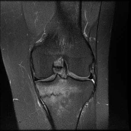 Medial Tibial Stress Syndrome Mri