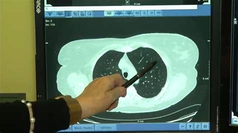 Secret Signs Of Cancer Ivanhoe Broadcast News Inc