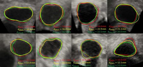 Manual Tracing Obs1 Yellow Obs2r Green And Automated Segmentation