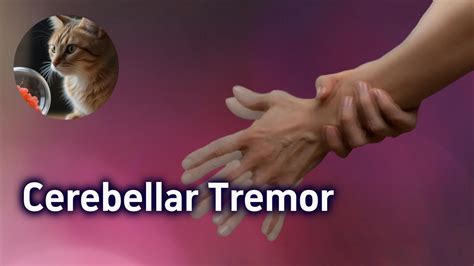 Usmleuworld Cerebellar Tremor Vs Essential Tremor Vs Parkinson