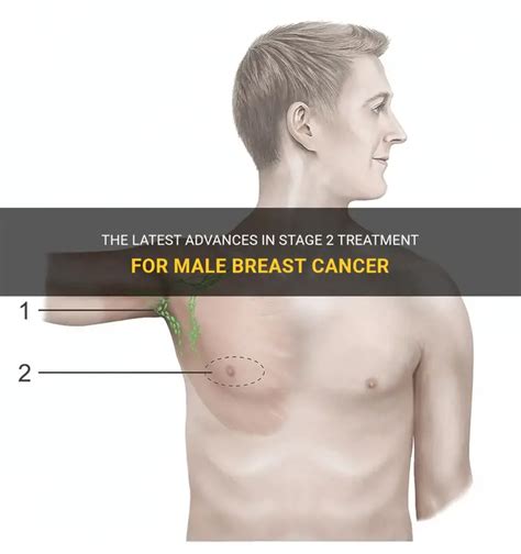 The Latest Advances In Stage 2 Treatment For Male Breast Cancer Medshun