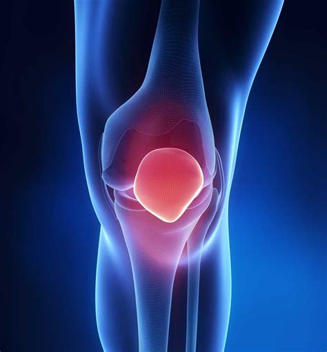 Quadriceps Dysfunction In Patello Femoral Pain Syndrome