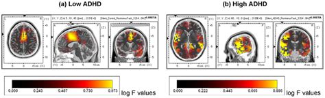 Localisation Of Attention Induced Deactivation Of Vlf Eeg 00202 Download Scientific Diagram