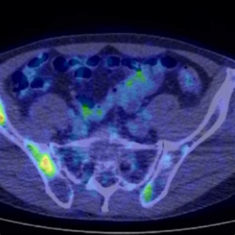 In The Case 1 Multiple Bone Metastases Were Suspected By A Positron Download Scientific