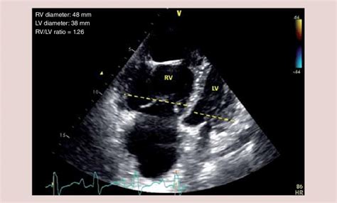 Right Ventricle Dilation After Pulmonary Embolism Relevant Rv Dilation