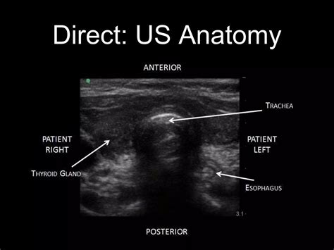 Ultrasound Confirmation Of Ett Placement Ppt