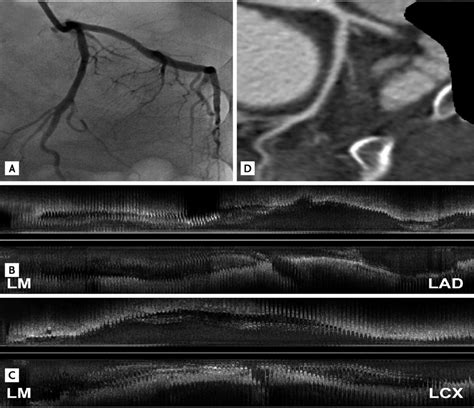 A Coronary Angiography Revealed Mild Stenosis In The Proximal Parts