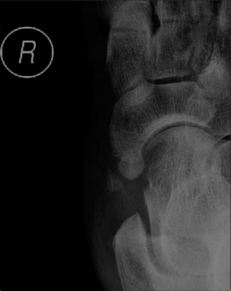 Multiossicle Accessory Navicular Bones A Symptomatic Presentation Of Rare Variant Anatomy