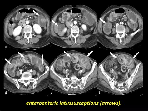 Presentation1pptx Radiological Imaging Of Intusussception Ppt