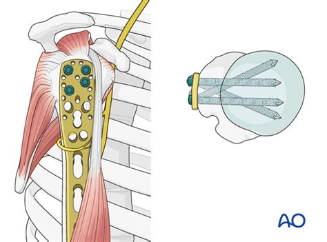 Orif Plate Fixation Proximal 1 3 For Multifragmentary Fracture Fragmentary Segment