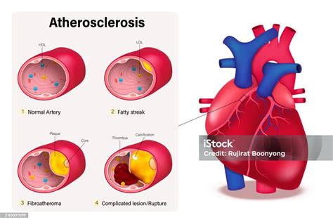 Ilustración De Etapas Del Vector De Aterosclerosis Enfermedad