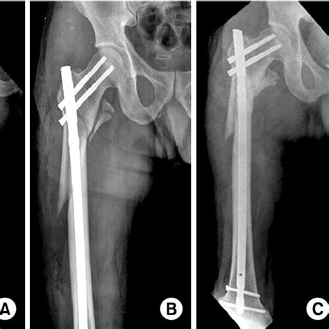 A A 49 Year Old Male Sustained Winquist Hansen Type Iv Otaao Type