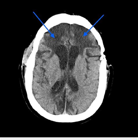 Ct Of The Head Horizontal Cut Showing Frontal Lobe Atrophy Blue Download Scientific Diagram
