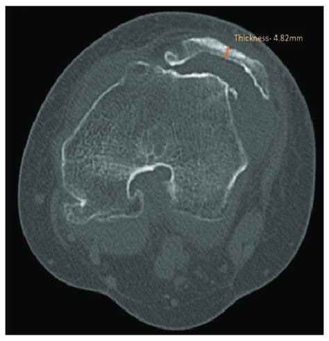 Pre Operative Computed Tomography CT Scan Axial Section Showing The