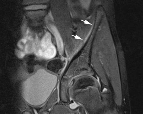 Iliac Crest Muscle Attachments