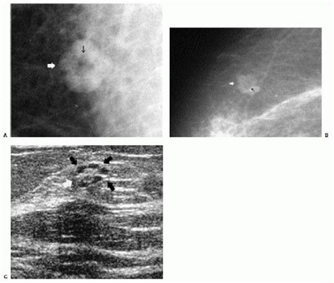 Benign Masses Radiology Key
