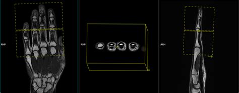 Mri Fingers Finger Mri Protocol And Planning
